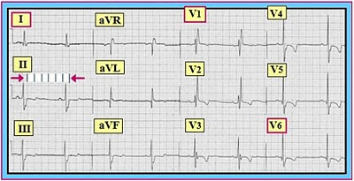 ECG Interpretation: ECG Interpretation Review - #3 (BBB, Wide QRS, BBB ...