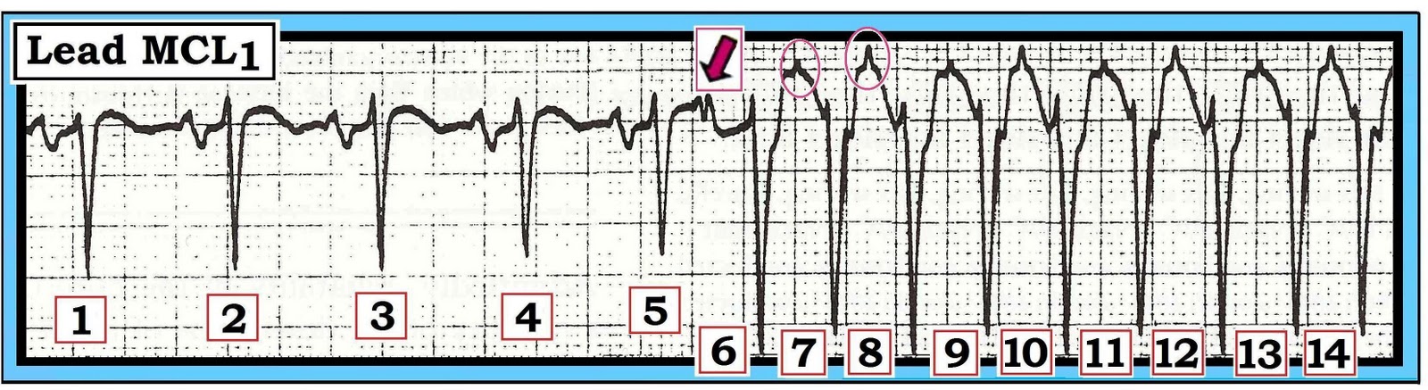 ECG Interpretation: ECG Interpretation Review #15 (Run of WCT - VT vs ...