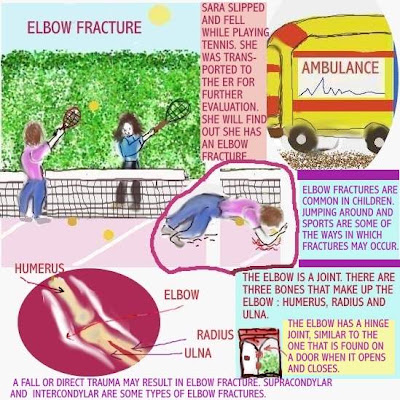 Dear Nurses: ELBOW FRACTURE AND ITS CONSEQUENCES