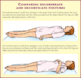 Neurology 2011: Comparing decerebrate and decortical posture