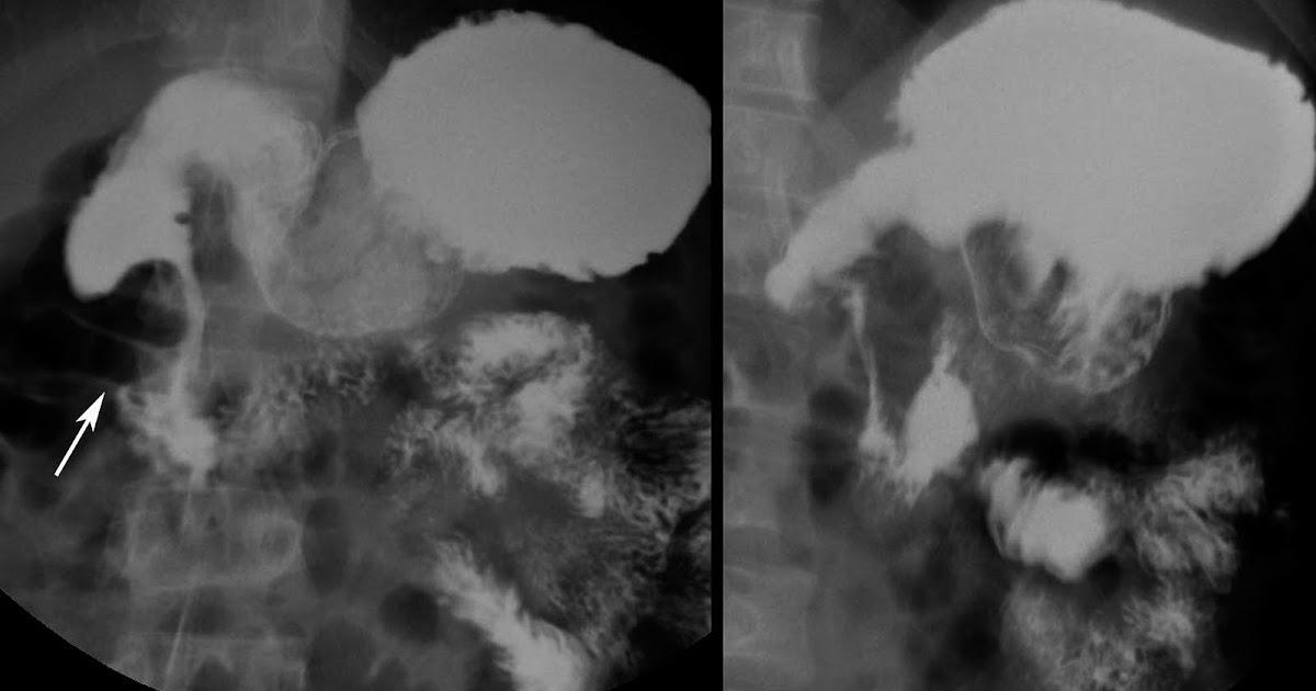 Annular Pancreas Radiology
