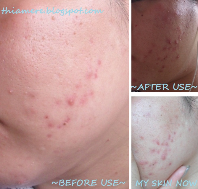 ~on beauty stuff and what else's....~: Clean & Clear Active Clear Acne ...