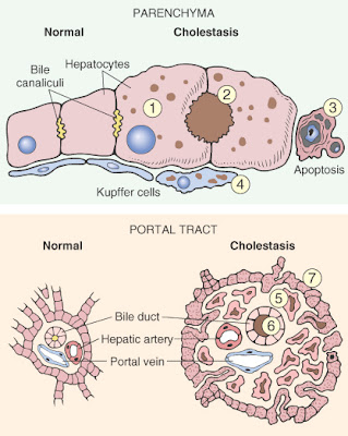 Hepatologia - Histologia: Colestase