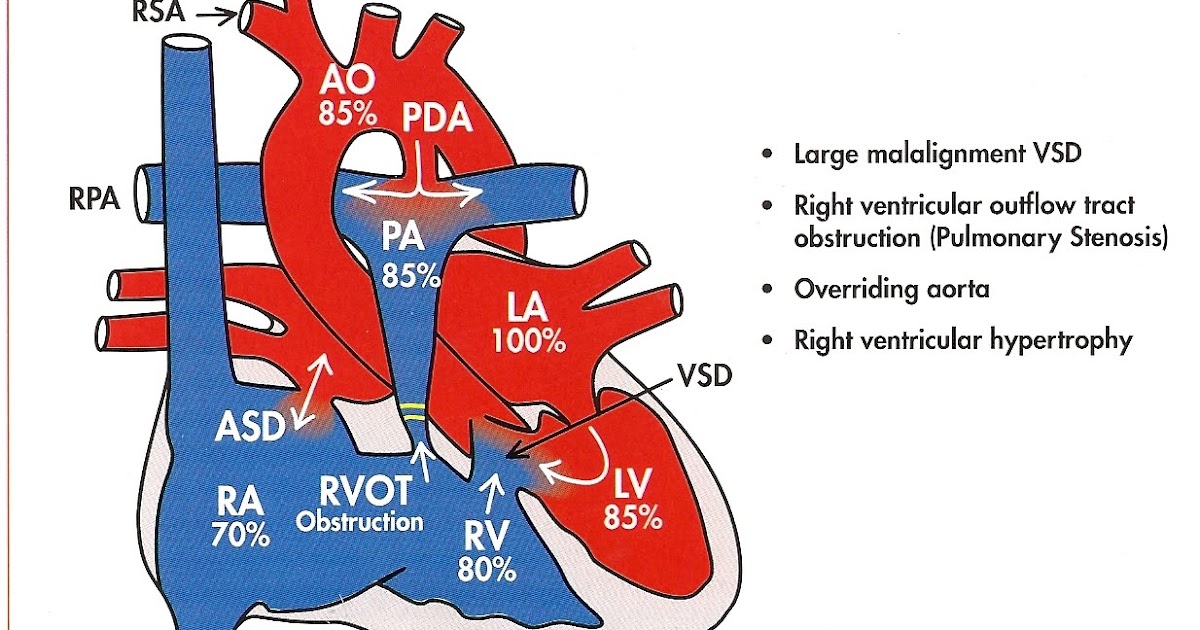 Heart defects, for everyone: Tetralogy of Fallot (TET)