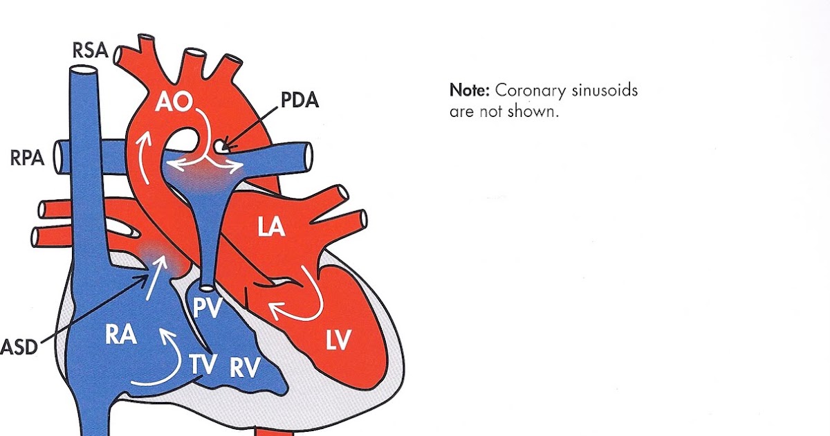Heart defects, for everyone: Hypoplasia of the Right Ventricle ...