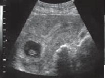 Endoscopia Ginecologica: Embarazo cervical