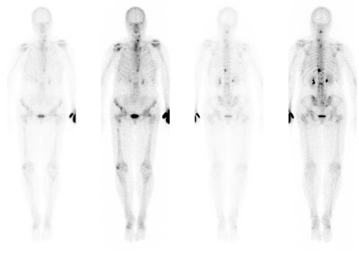 Fluorine-18...A Blog About Imaging: A Classic Bone Scan Finding? Not ...