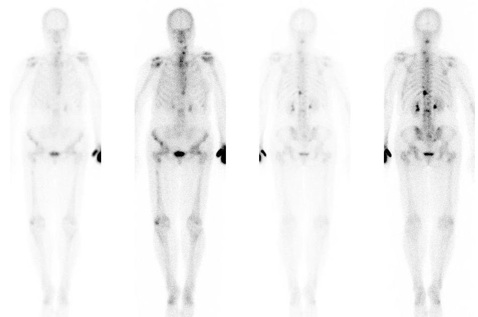 Fluorine-18...A Blog About Imaging: A Classic Bone Scan Finding? Not ...