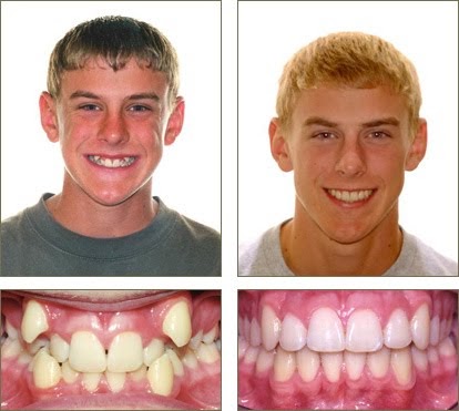 Before And After Braces Picture | Before And After Braces