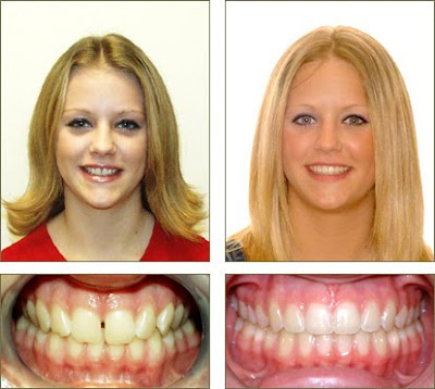 Before And After Braces Pic | Before And After Braces