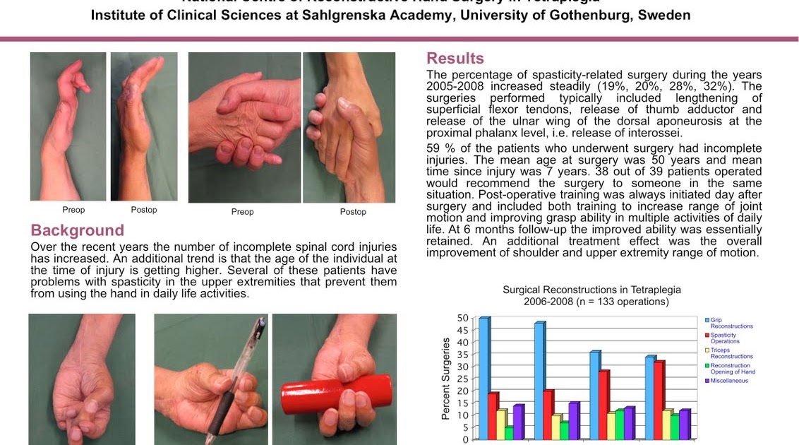 Tetrahand research: Current Trends in Surgical Treatment of Spasticity ...