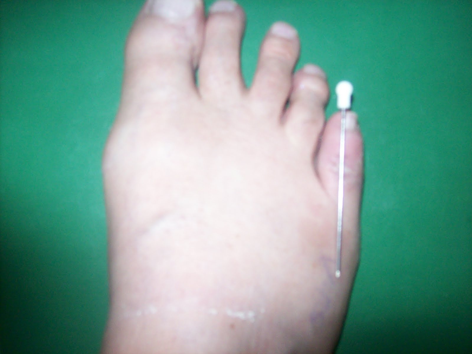 Stuff and Nonsense: Goodbye pins, hello unbendable pinky toes!