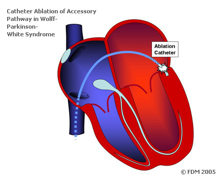 Wolff-Parkinson-White (WPW) Syndrome