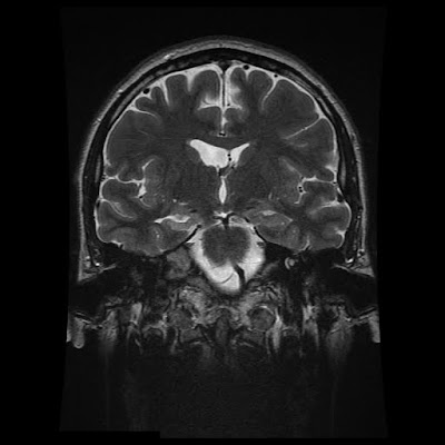 Radiology Cases: Mesial Temporal Sclerosis