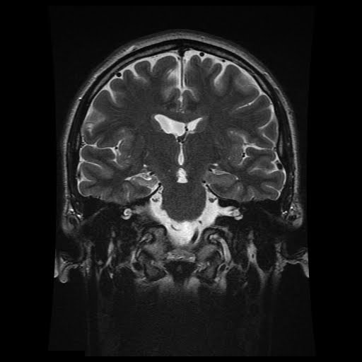 Radiology Cases: Mesial Temporal Sclerosis