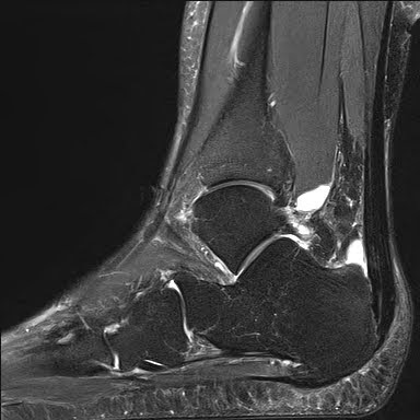 Radiology Cases: Haglund's Deformity and Syndrome