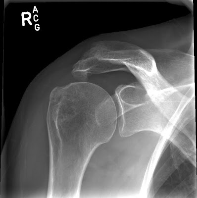 Radiology Cases: Subacromial Spur