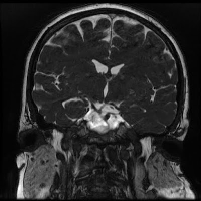 Radiology Cases: Persistant Trigeminal Artery, Saltzmann I