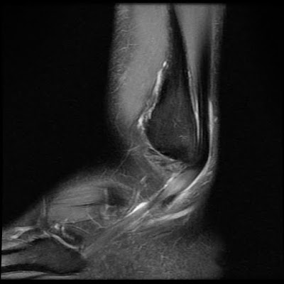 Radiology Cases: Peroneus Brevis Split Tear and Lateral Subluxation of ...