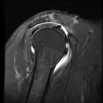 Radiology Cases: Subcoracoid Impingement and Subscapularis Tear