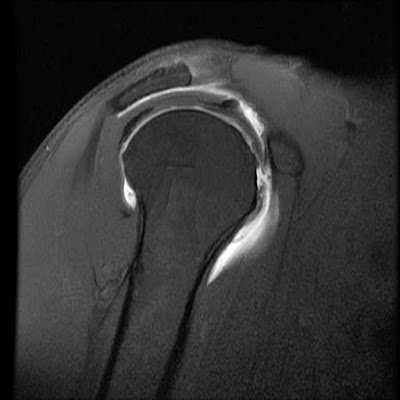 Radiology Cases: Subcoracoid Impingement and Subscapularis Tear
