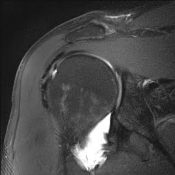 Radiology Cases: Old HAGL Lesion