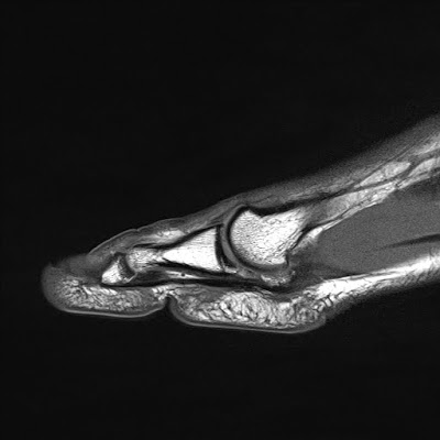 Radiology Cases: Plantar Plate Tear