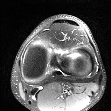 Radiology Cases: Parrot Beak Tear = Non displaced flap tear