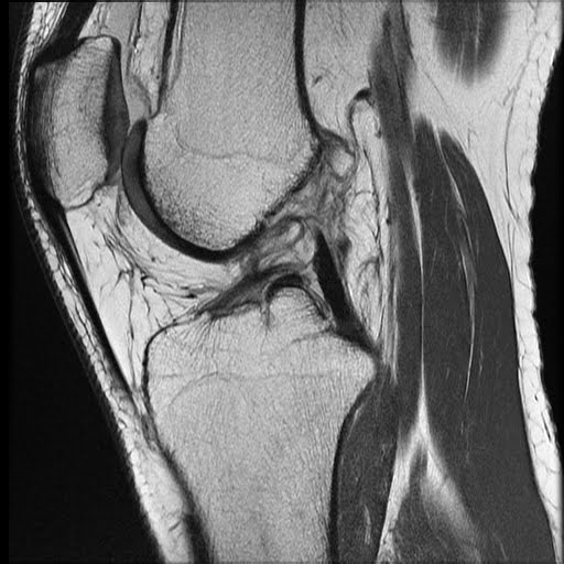 Radiology Cases: Double Delta Sign and Deep Lateral Sulcus Sign