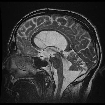 Radiology Cases: Normal Pressure Hydrocephalus and Inferior Vermian ...