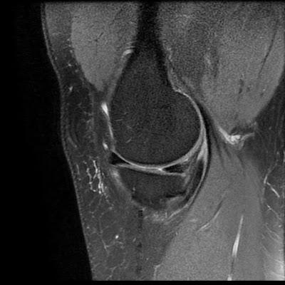 Radiology Cases: Parrot Beak Tear