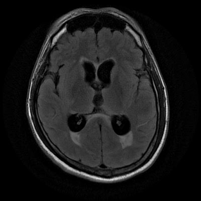 Radiology Cases: TB Meningitis with Acute Hydrocephalus and Splenium ...