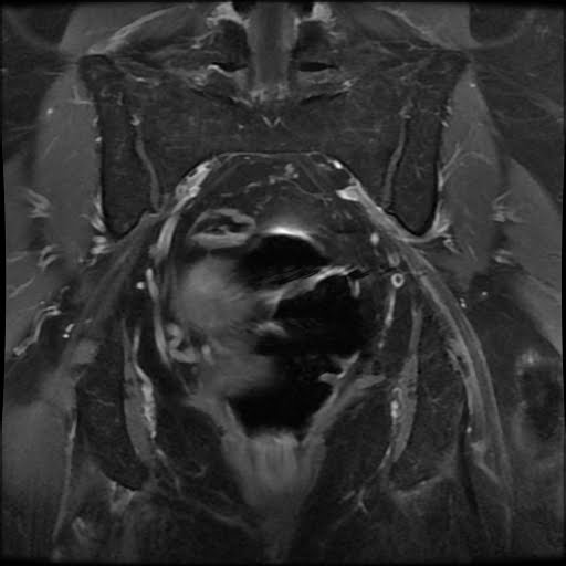 Radiology Cases: Lumbar Plexopathy