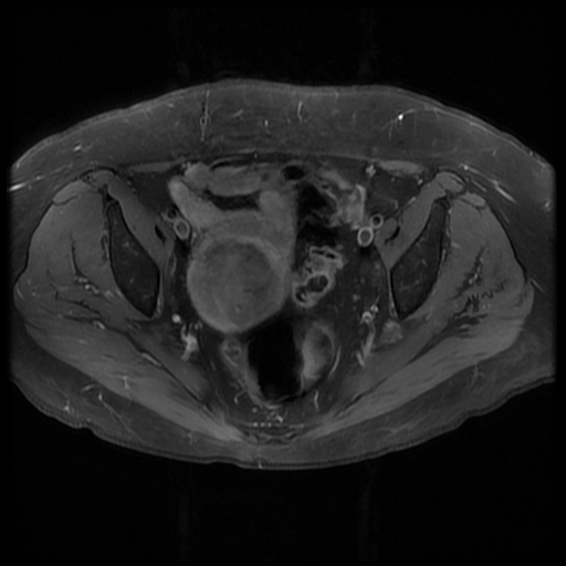 Radiology Cases: Lumbar Plexopathy