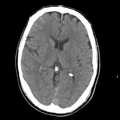 Radiology Cases: Subtle SAH on CT, Easy on FLAIR