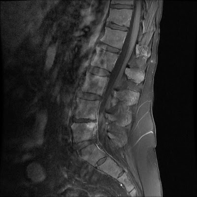 Radiology Cases: Discitis and Vertebral Osteomyelitis with Small ...
