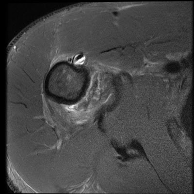Radiology Cases: HAGL Lesion, Greater Tuberosity Fracture and SS Tear