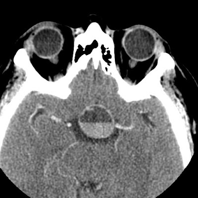 Radiology Cases: Macroadenoma