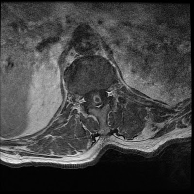 Radiology Cases: Intramedullary Abscess (involving the conus)