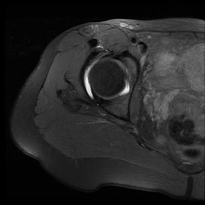 Radiology Cases: Postero-Superior Labral tear