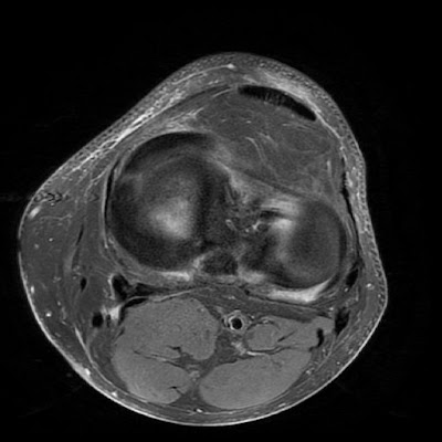Radiology Cases: Meniscal Radial Tear