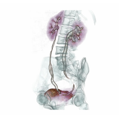 Radiology Cases: CT IVP
