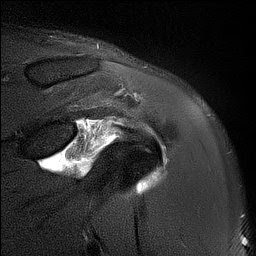 Radiology Cases: Rotator Interval Tear