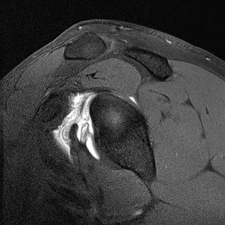 Radiology Cases: Rotator Interval Tear