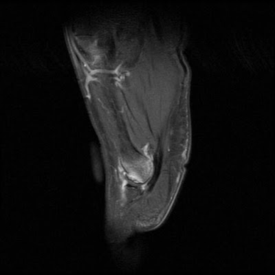 Radiology Cases: Freiberg's Disease