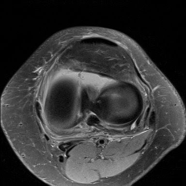 Radiology Cases: ACL Tear and Wrisberg Rip