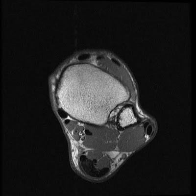Radiology Cases: Peroneus Quartus
