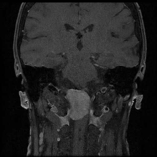 Radiology Cases: CCJ Meningioma