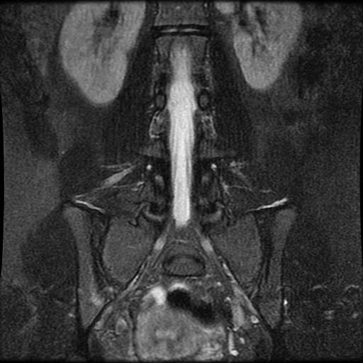 Radiology Cases: Unilateral sacroiliitis