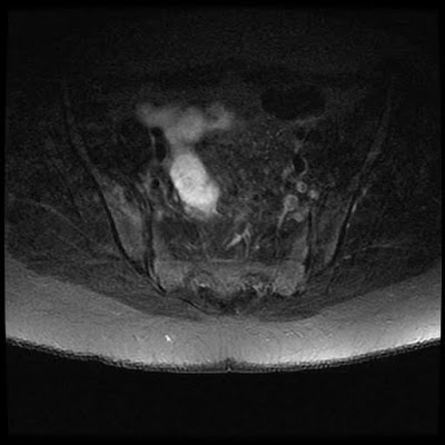 Radiology Cases: Unilateral sacroiliitis